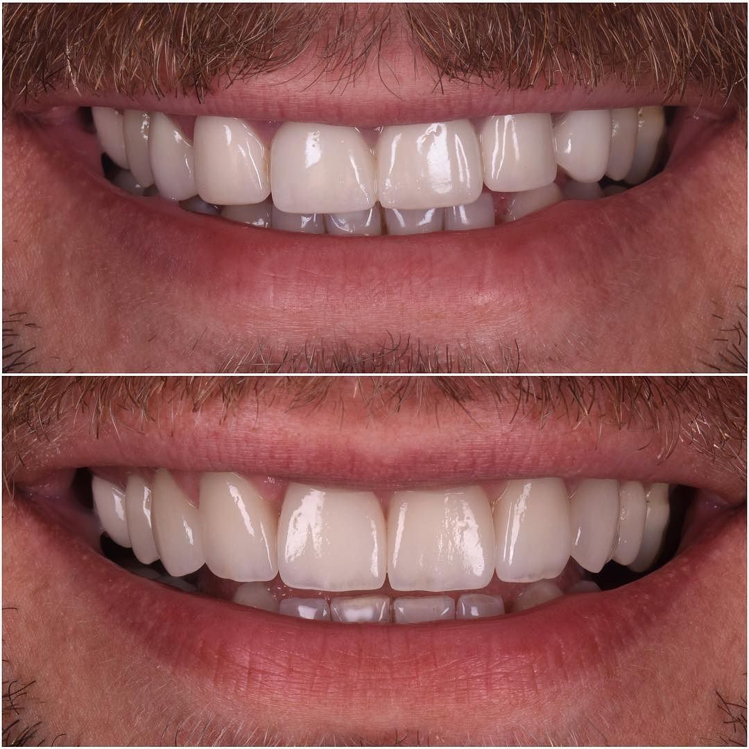 Emax Veneers - Beautiful Smiles in Birmingham