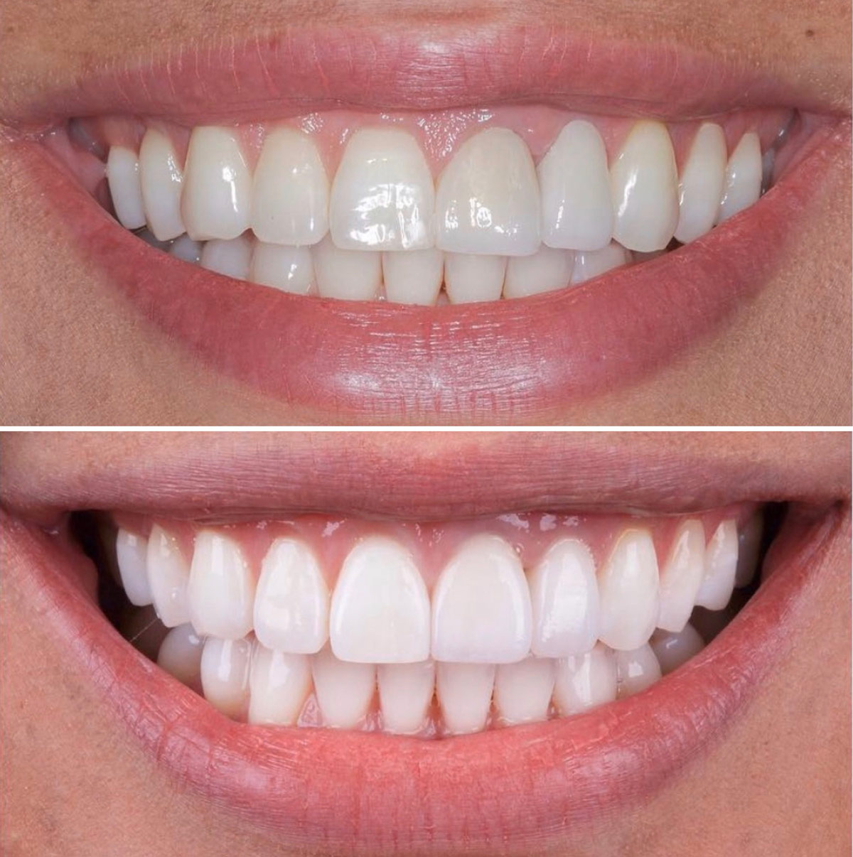 Emax Veneers - Beautiful Smiles in Birmingham