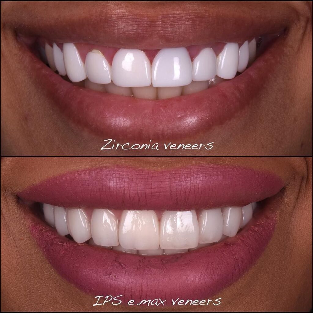 Emax Veneers - Beautiful Smiles in Birmingham